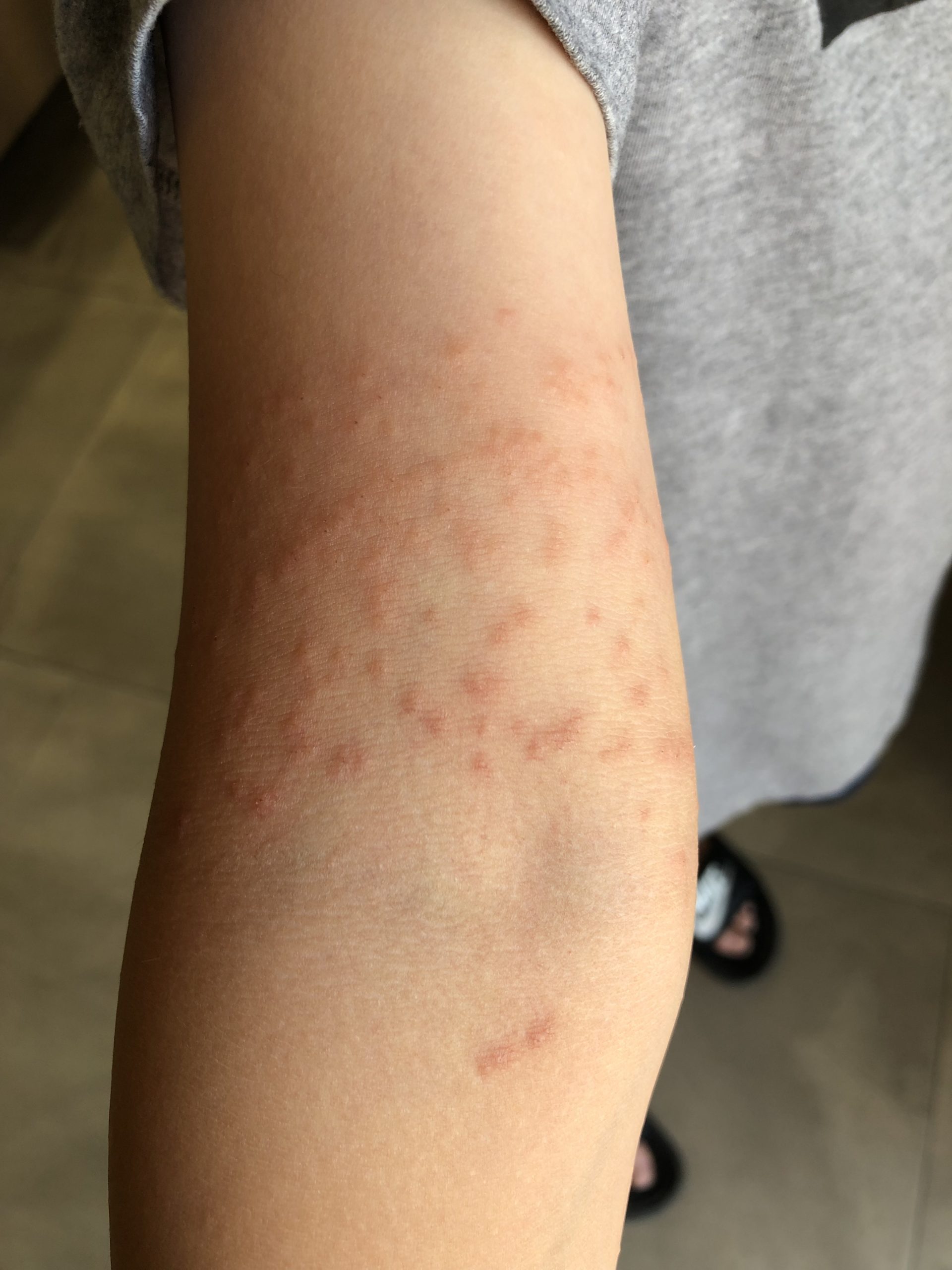 Remedy A Suspected Scabies Infestation Vim And Co